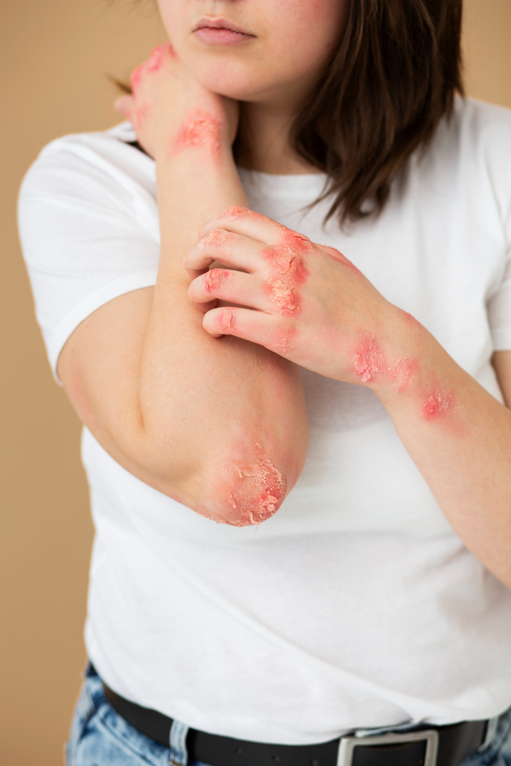 Everything About Dermatitis and Atopic Dermatitis - Agrosloven
